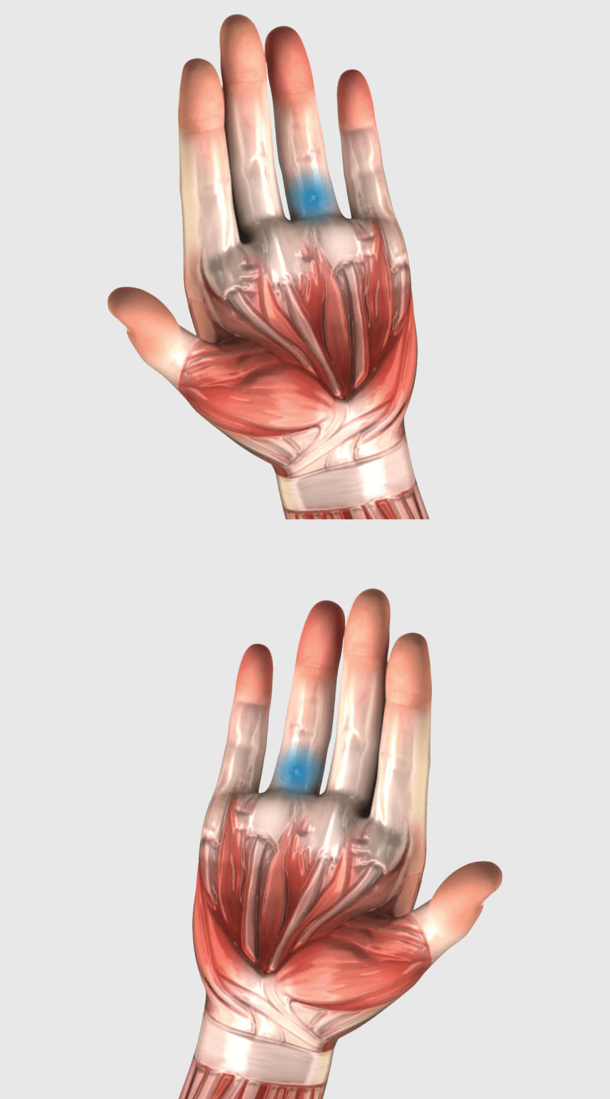 Pulley Sprain Injury Protocol - Rock Rehab Pyramid for Rock Climbers